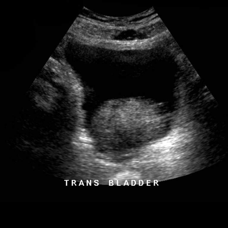 Καλοηθής Υπερπλασία του Προστάτη (ΚΥΠ) » ΟΥΡΟΔΙΑΓΝΩΣΗ